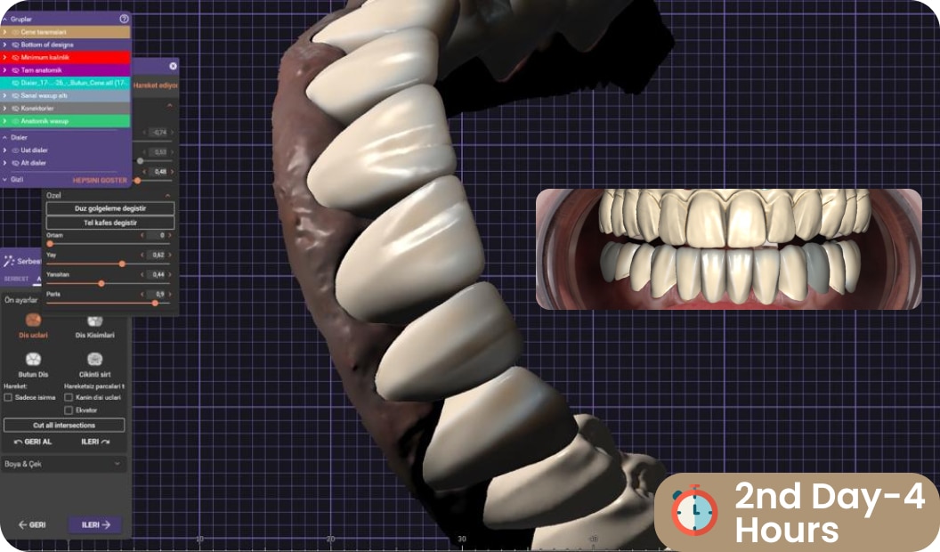 Smile Design Antalya, Turkey - Denta Fly