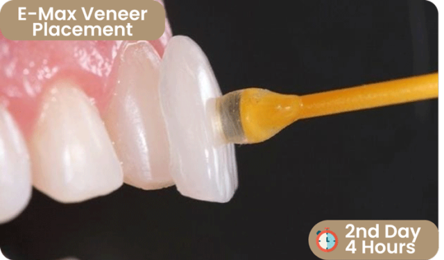 Antalya E-max Laminate Veneers Prices Features