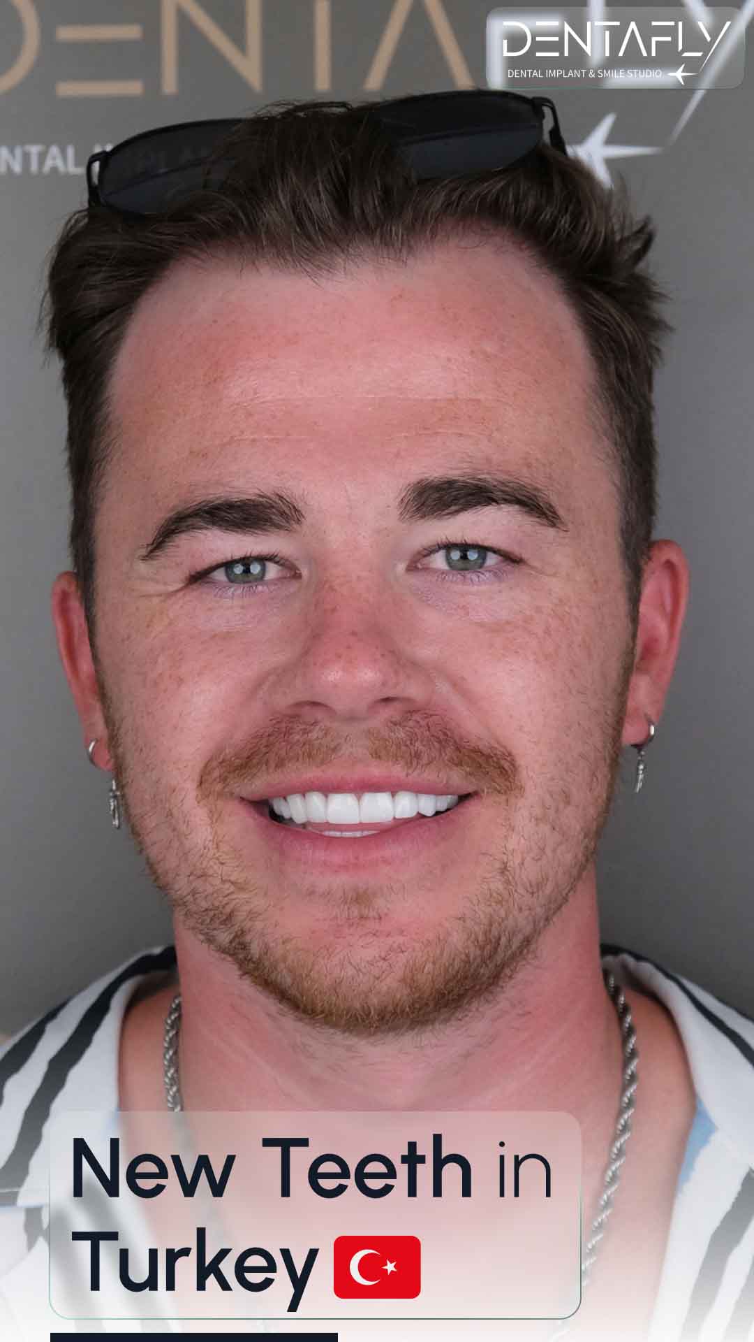 New Teeth in Turkey: Costs, Packages, Procedure 2023