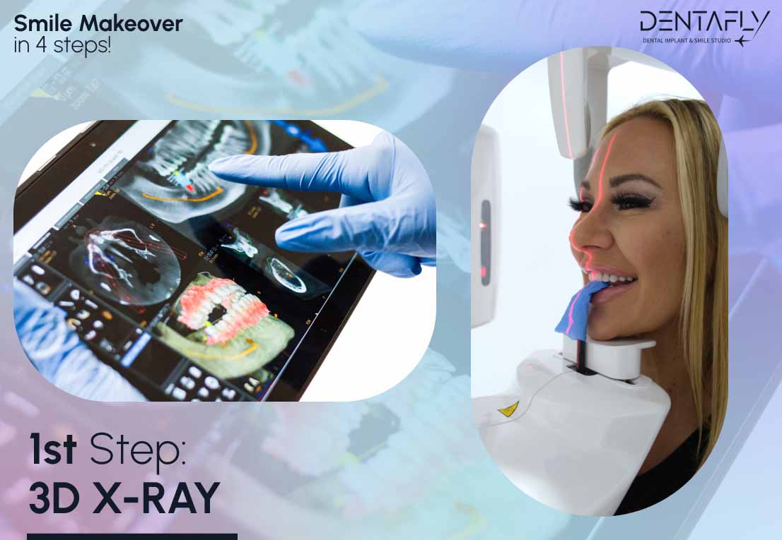 Smile Makeover in Turkey: Cost, Before After, Deals