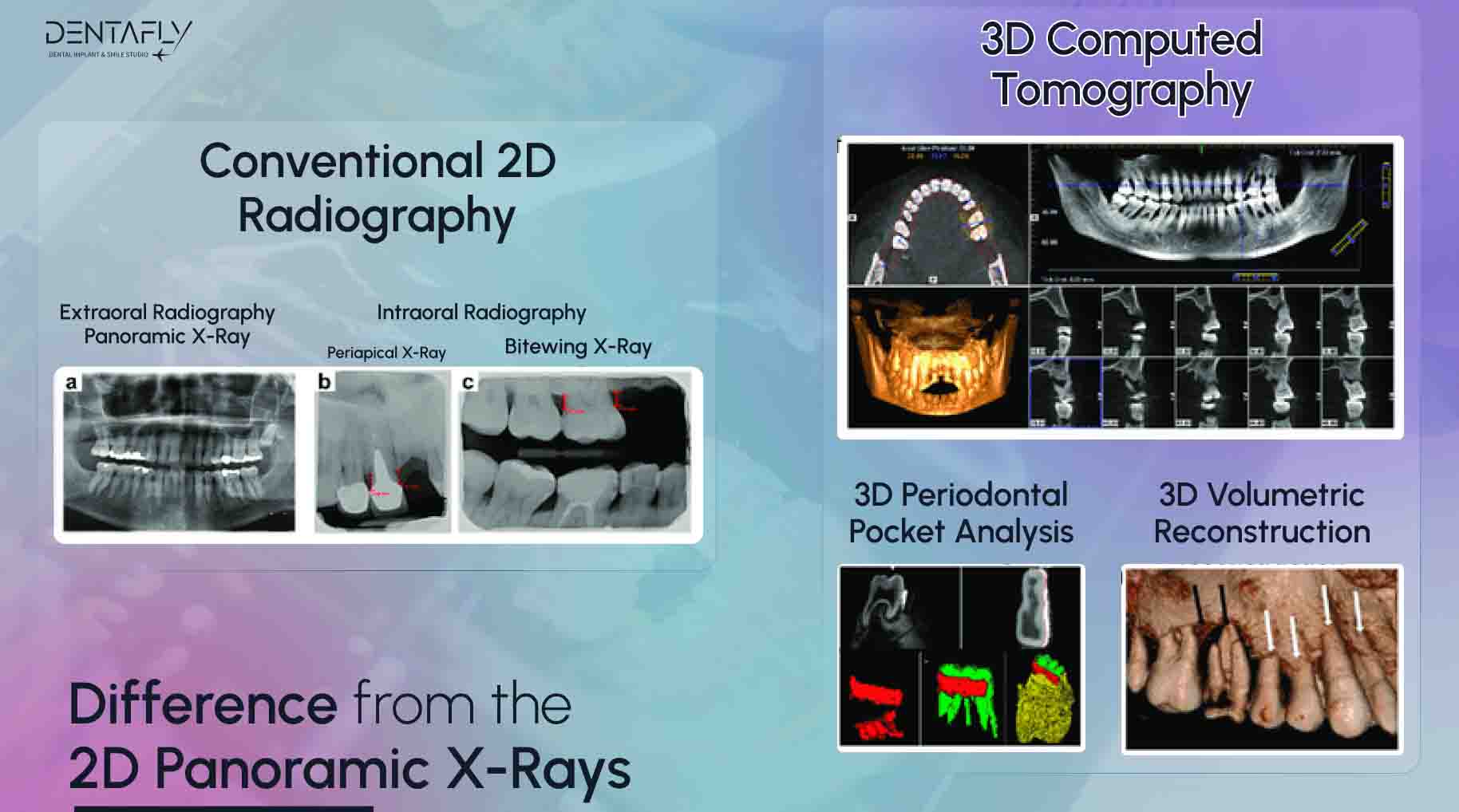 What is 3D X-Ray? Usage in Dental Treatment - Denta Fly