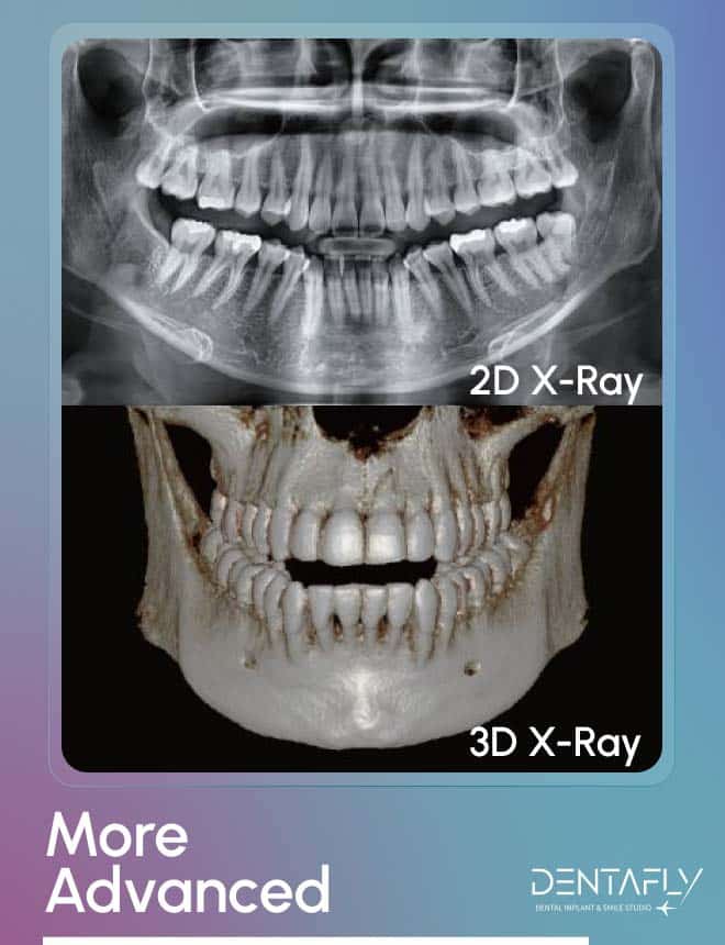 What is 3D X-Ray? Usage in Dental Treatment - Denta Fly