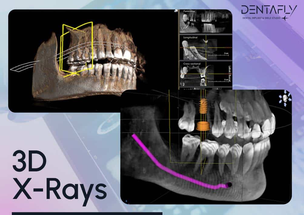 What is 3D X-Ray? Usage in Dental Treatment - Denta Fly