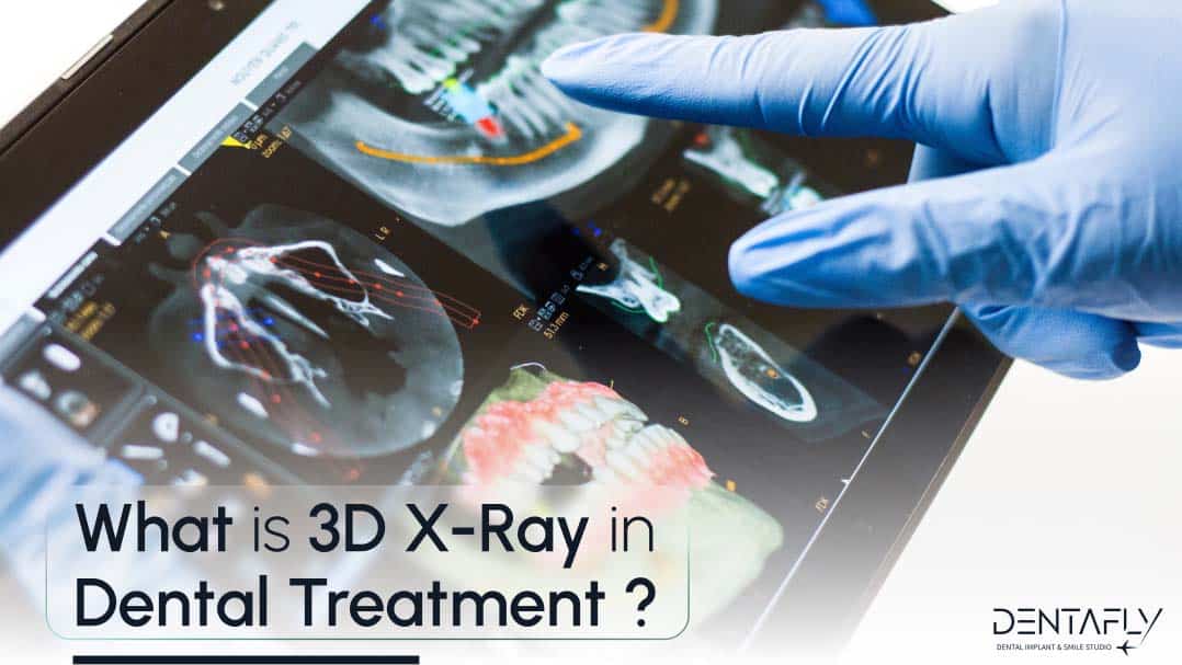 What is 3D X-Ray? Usage in Dental Treatment - Denta Fly