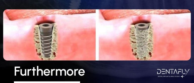 Osseointegration A to Z: Dental Implant Bone Fusion