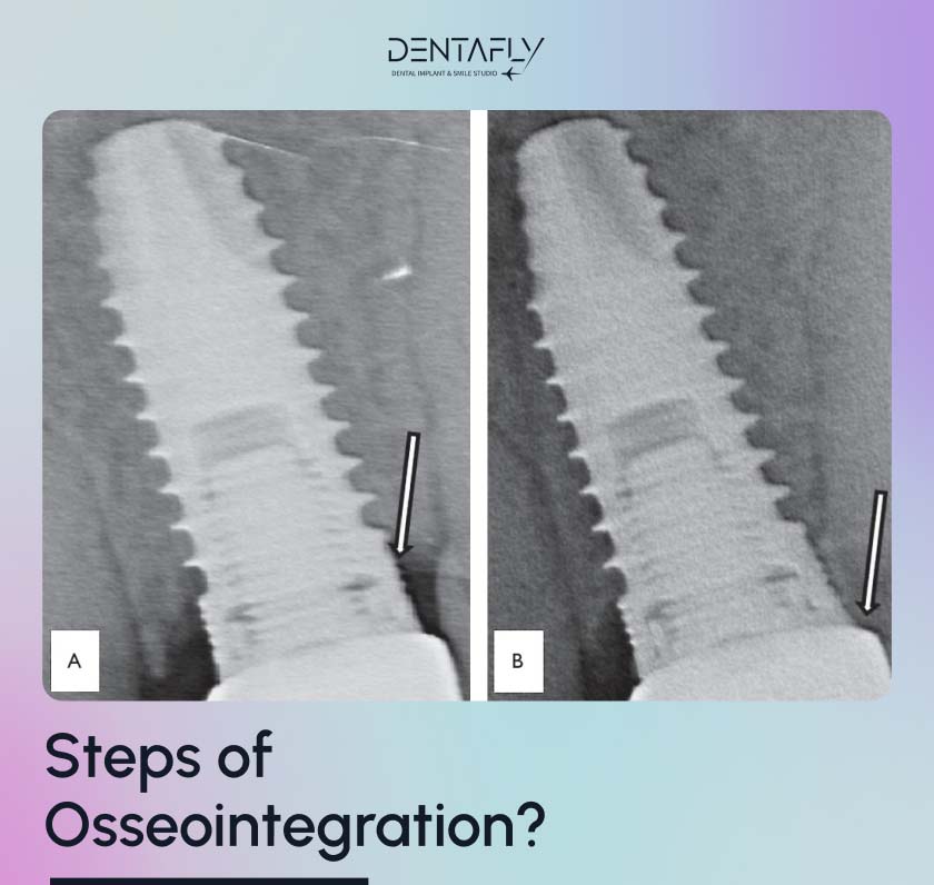 Osseointegration: A to Z Overview - Denta Fly