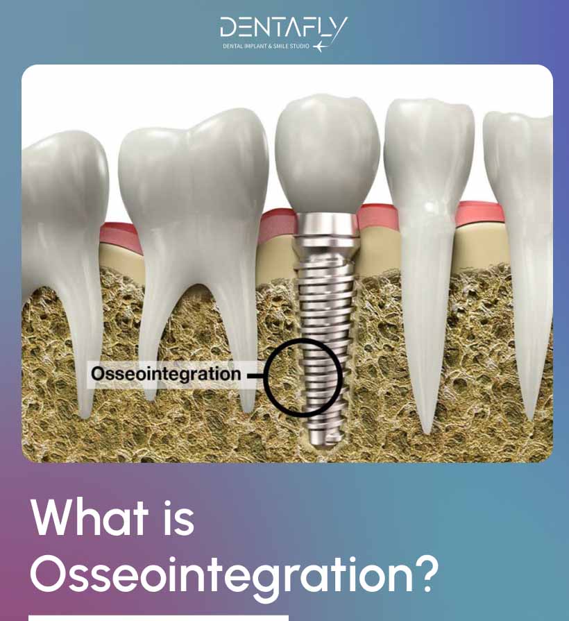 Osseointegration: A to Z Overview - Denta Fly