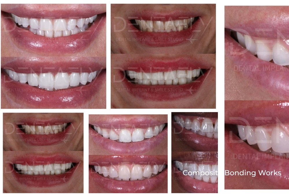 Composite Bonding in Turkey - DentaFly Top 10+