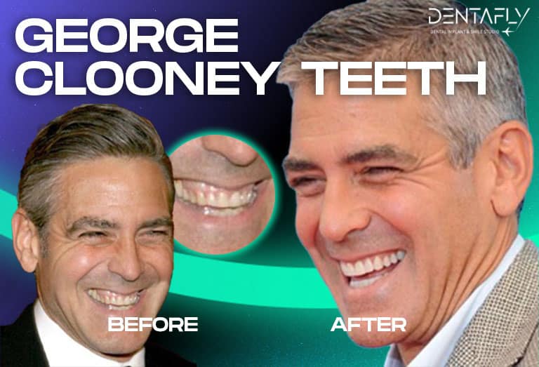 Celebrity Teeth: Incredible Transformations of 20 Stars