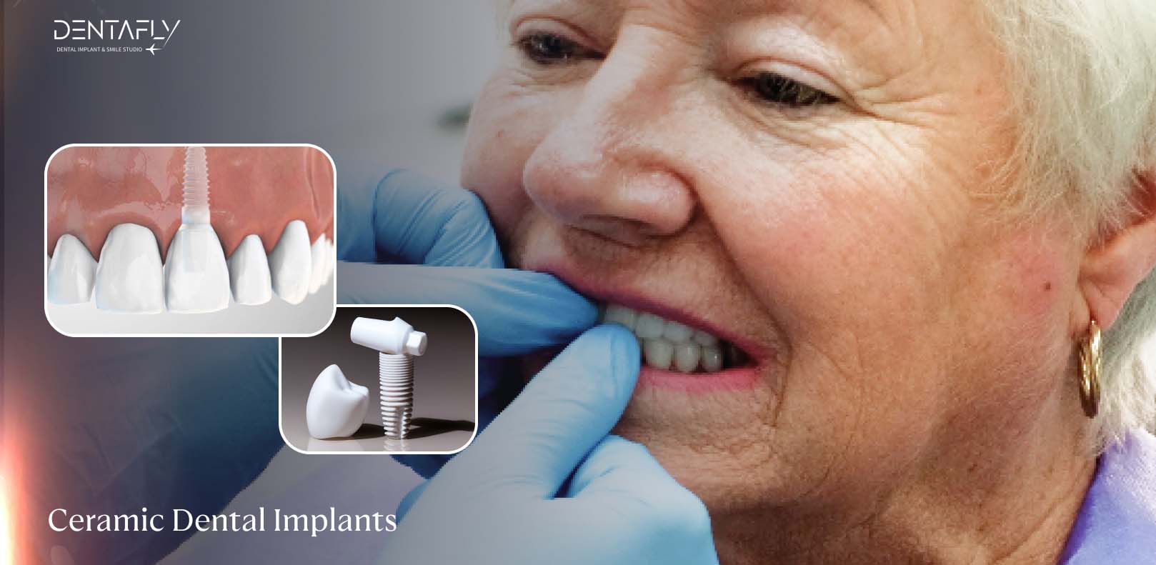 Ceramic Dental Implants Turkey: Aesthetic Oral Rehabilitation