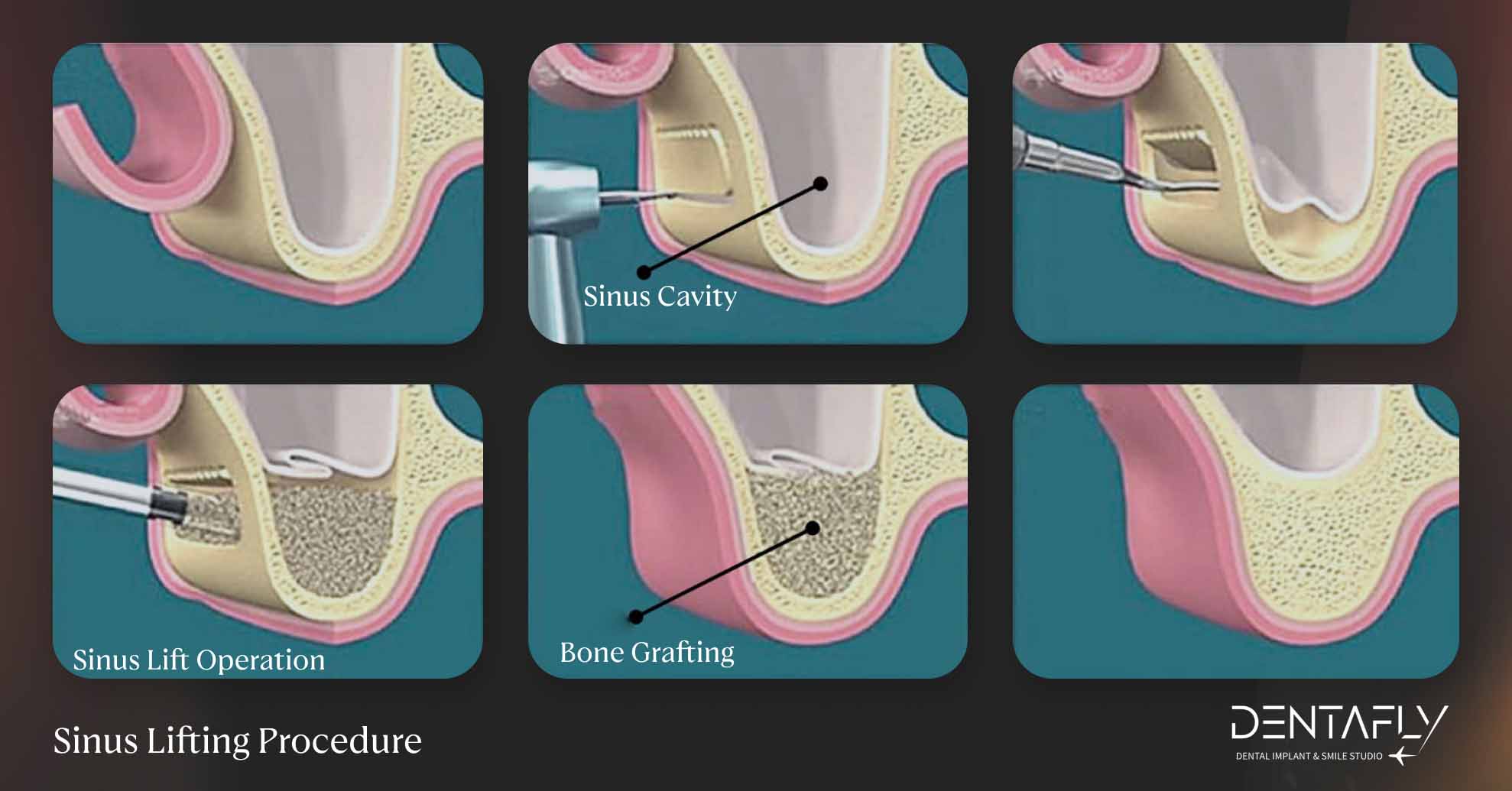 Lateral Window Approach in Sinus Lifting Surgery in Turkey