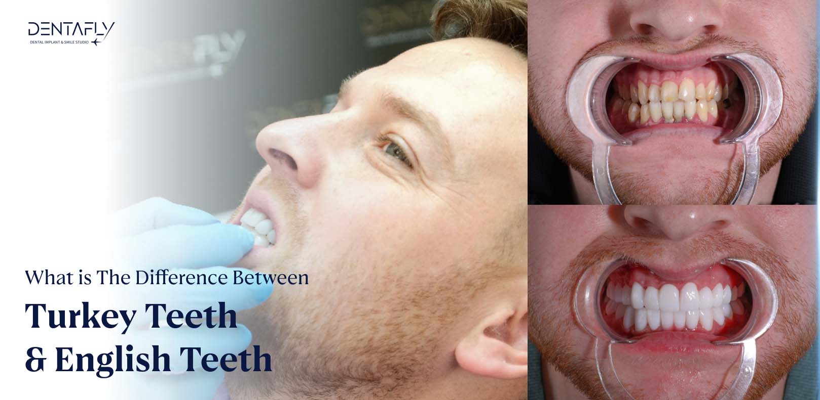 Turkey Teeth vs English Teeth: Key Differences Explained