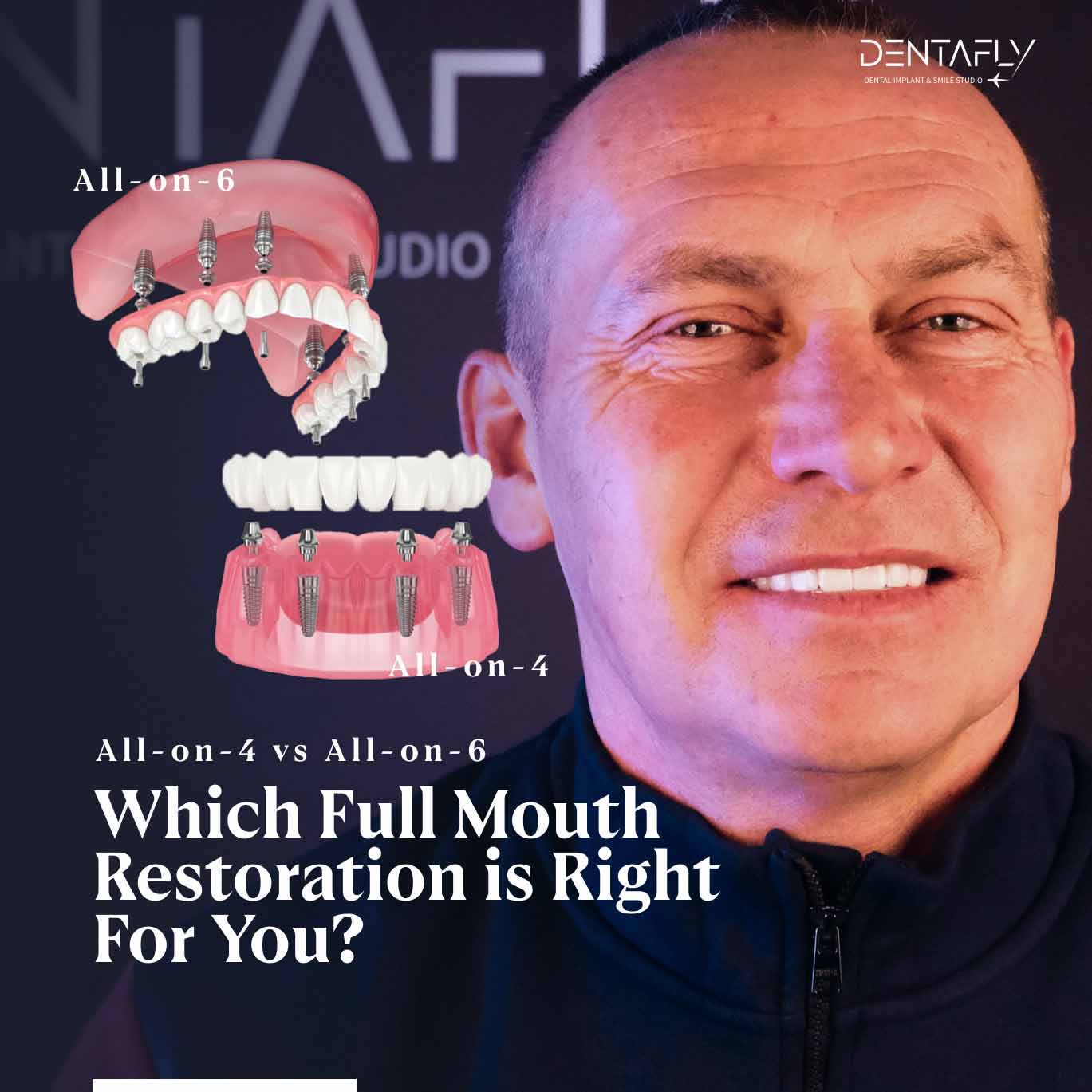 All-on-4 vs. All-on-6: Which Full Mouth Restoration is Best?