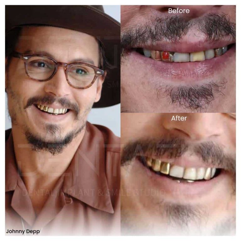 Johnny Depp’s Dramatic Smile Makeover: Before & After Photos