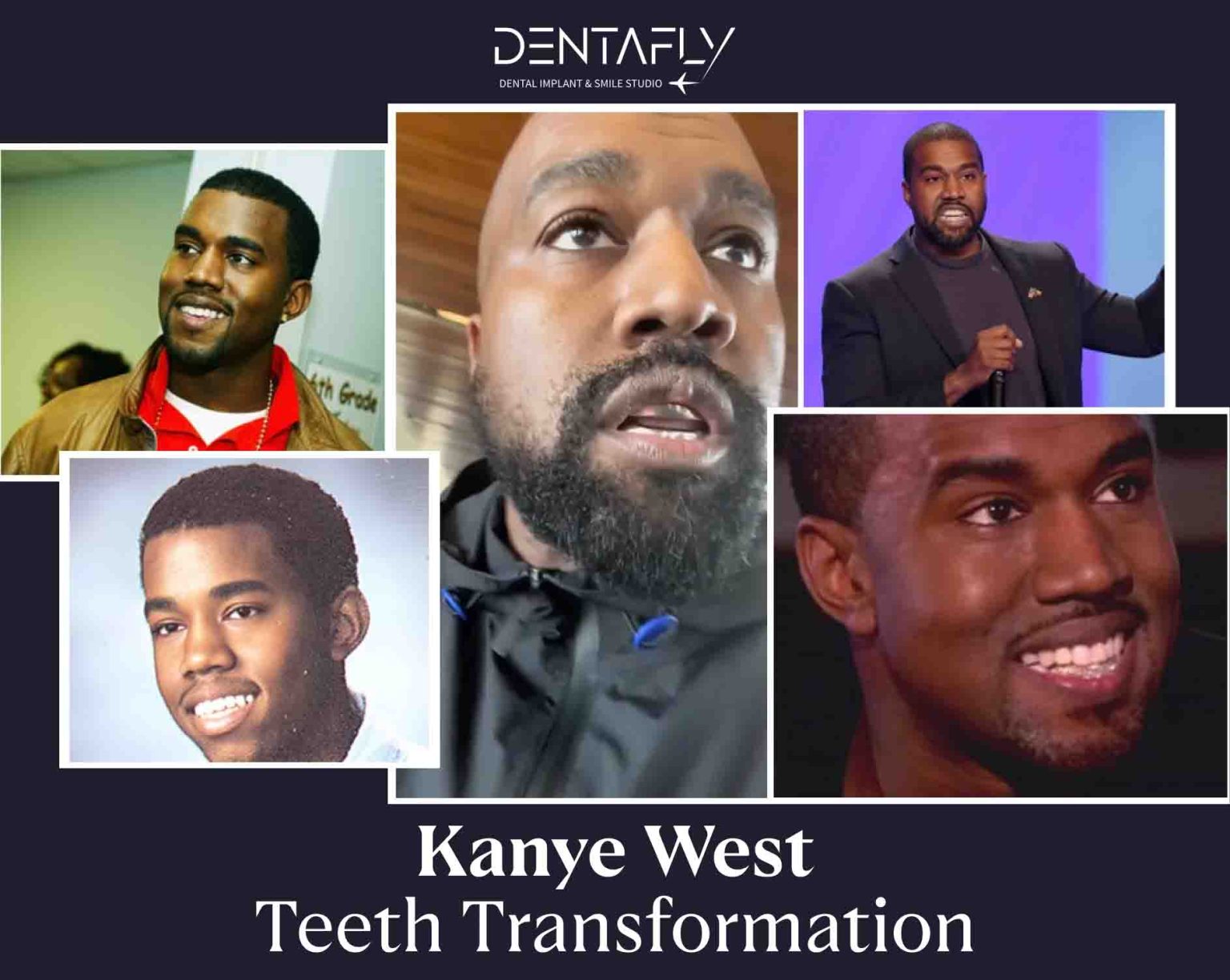 Kanye West Teeth: $850K Titanium Transformation Story